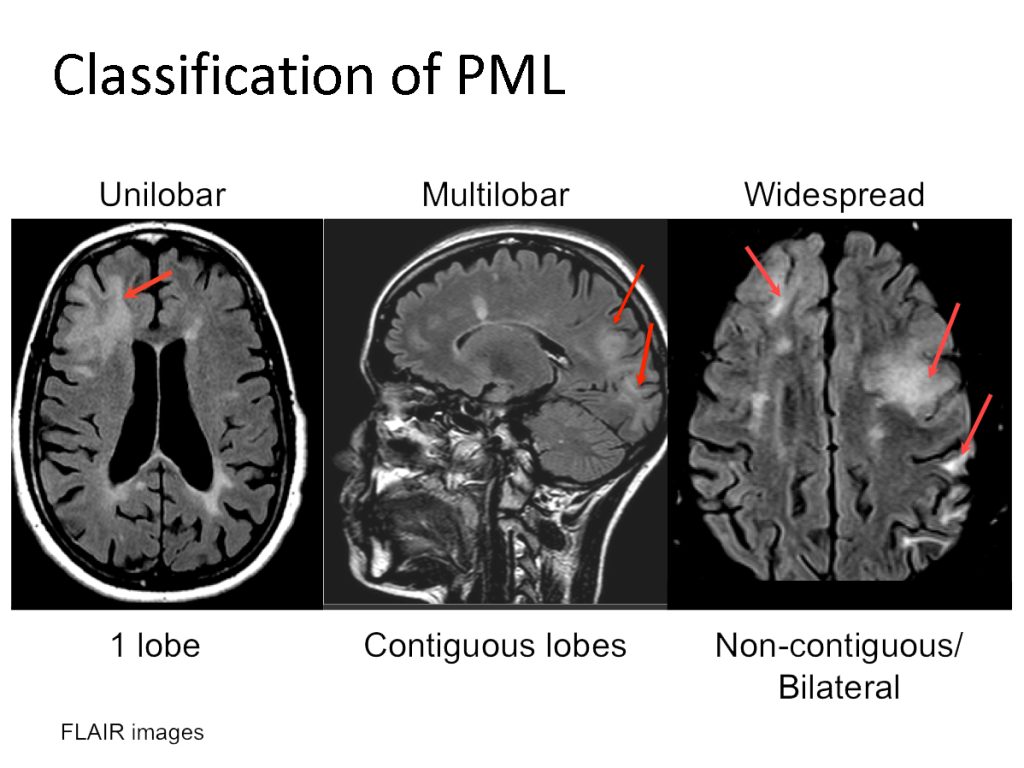 PML Management - Neuro-Outaouais